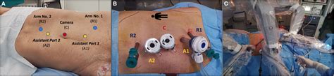 Overview Of Port Placement In Our Case Of Robot Assisted Partial