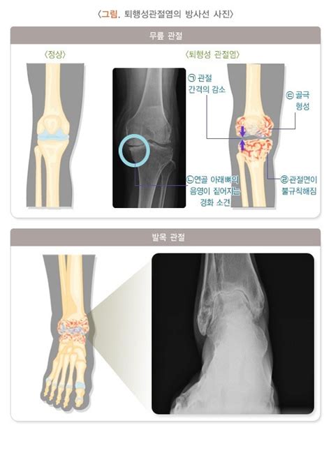 골관절염 증상과 치료 방법
