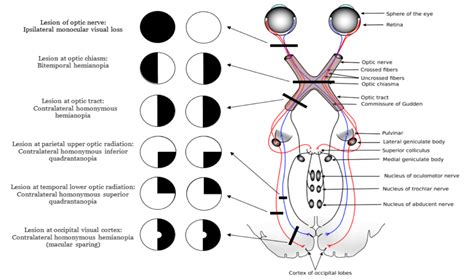 Optic Tract Vs Optic Radiation At Georgia Lai Blog