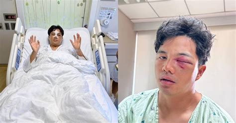 吳念庭遭「強襲球擊中」出院了！ 傷勢正面照曝光 生活 Ctwant