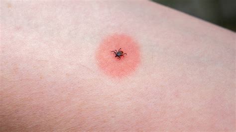 Comment savoir si la tête de la tique est restée Ça m intéresse