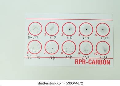 Стоковая фотография 2211762053 Rpr Vdrl Syphilis Test Glass Slide