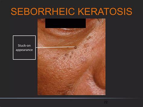 Overview Of Hyperpigmentation Disorders Pptx