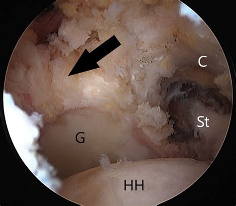 After Subacromial Bursectomy And Resection Of The Remaining Rotator