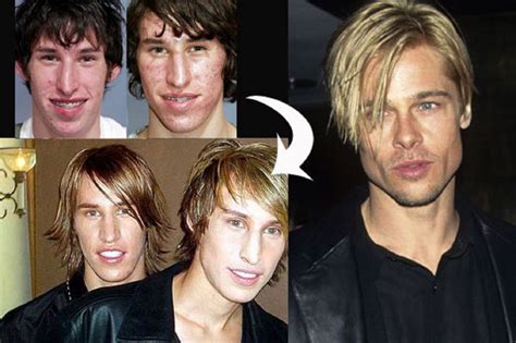 3 Matt Rife Plastic Surgery Cades Clinic
