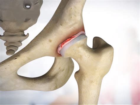 Réparation De Labrum Institut De Chirurgie Spécialisée De Montréal