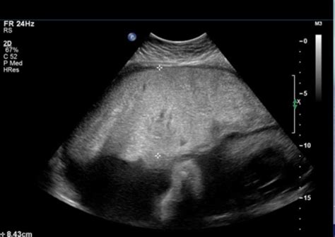 Placenta Abnormalities Flashcards Quizlet