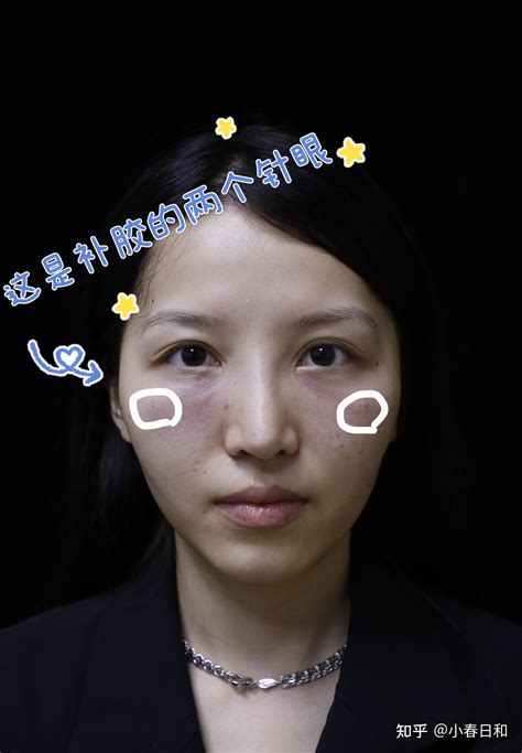 时隔五个月泪沟补胶，眼袋过程完结！ 知乎