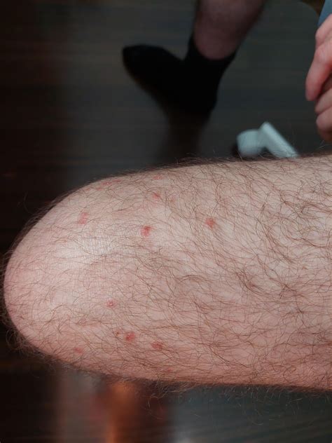 Red Itchy Bumps On Legs And Arms Only What Is This R