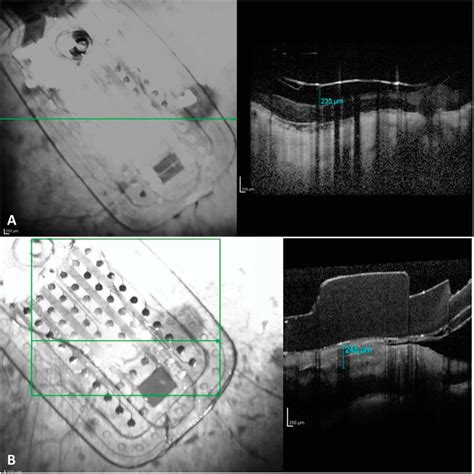 Postoperative Horizontal SD OCT Scan Of The Macula One Month After Download Scientific Diagram