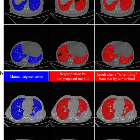 examples of segmentation at axial slices in each sub figure there are