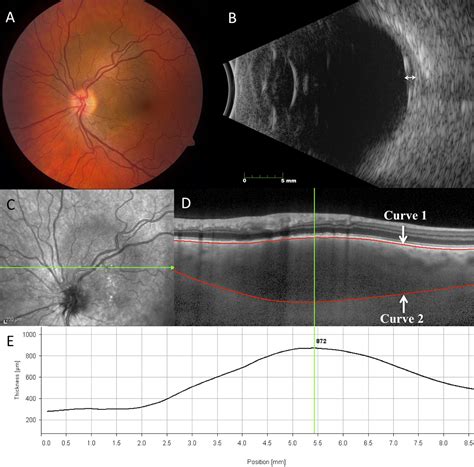 Enhanced Depth Imaging Optical Coherence Tomography Of Choroidal Nevus