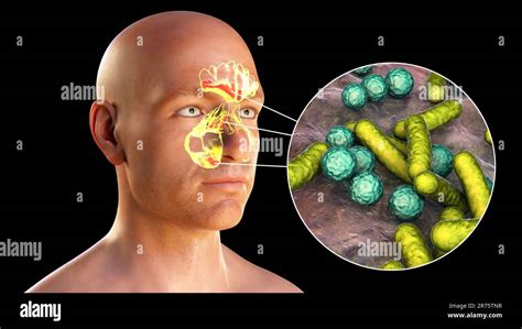 Sinusitis Inflammation Of Paranasal Cavities Computer Illustration