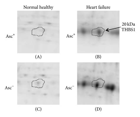 Validation Of Expression Profile Of Thrombospondin Thbs In Hf
