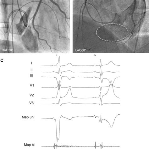 Cs Diverticulum In A 9year Old Female Patient 2 With Recurrent Svt