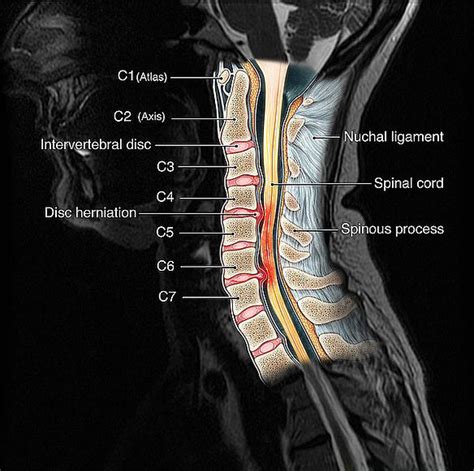 Abnormal Cervical Spine Mri