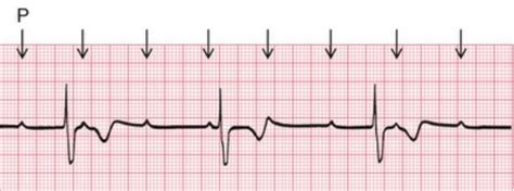 Cara Baca EKG Keperawatan Kritis