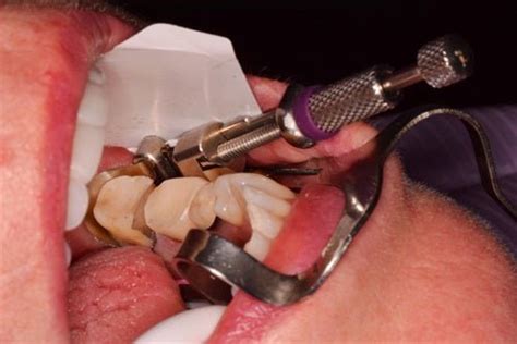 Lingual Root Class V Caries On 18 Greater Curve