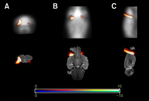 Spatial Parametric Mapping Spm Analysis Was Performed In Order To