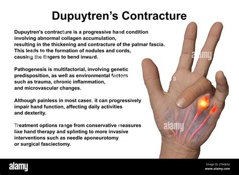 A 3d Medical Illustration Displaying A Patients Hand With Dupuytrens
