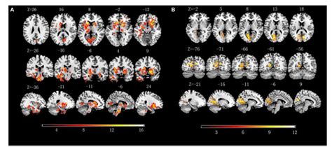 Alternations In Dynamic And Static Functional Connectivity Density In
