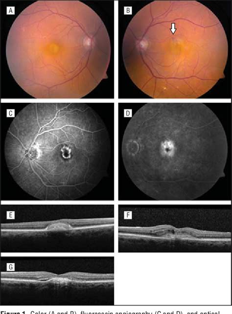 Figure 1 From Association Of Pattern Dystrophy With An Htra1 Single