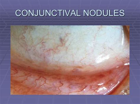 Ocular Manifestations Of Sarcoidosis Ppt Video Online Download