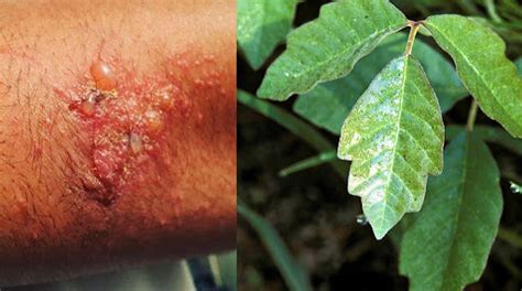 Discover Poison Oak Rash Symptoms And Remedies With Umedoc Umedoc