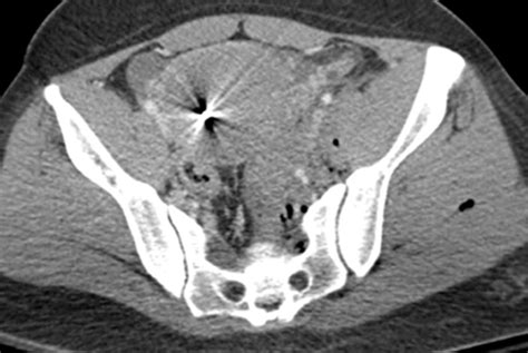 Imaging Of Trauma In The Pregnant Patient Radiographics