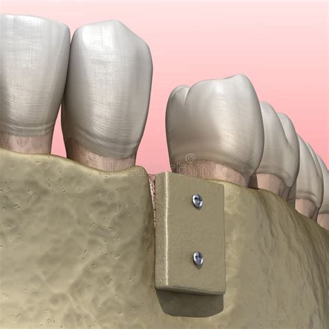 Augmentation Surgery Bone Transplantation Preparing For Implantation 3d Illustration Stock