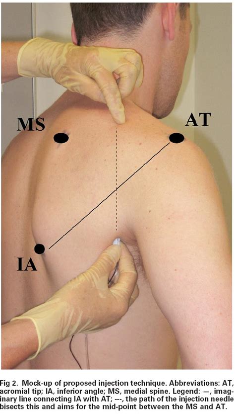 Injecting Subscapularis How Pain Medical Musing