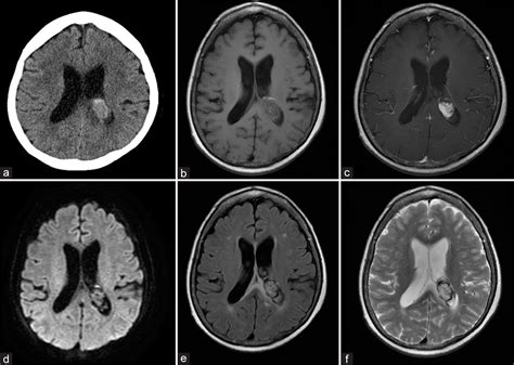 Surgical Neurology International