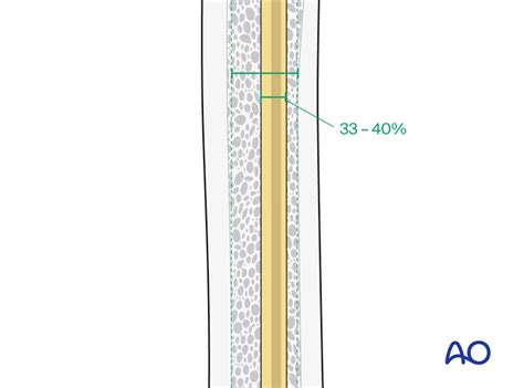 Elastic Nailing For Simple Transverse Tibial Fracture