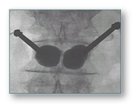 Osteoporotic Vertebral Compression Fractures Vcf The Uk Spine Centre