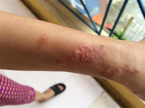 Giun đào Hầm Ngoáy Lộn Dưới Da Người Bị Nhiễm Giun Sán Từ Thú Cưng