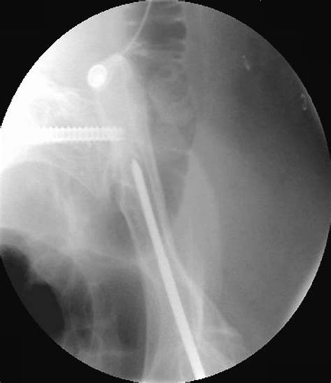 Acetabular Fractures Trauma Orthobullets