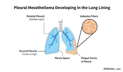 Malignant Pleural Mesothelioma Life Expectancy And Symptoms