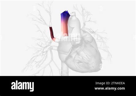 Right Superior Pulmonary Vein And Superior Vena Cava Stock Video