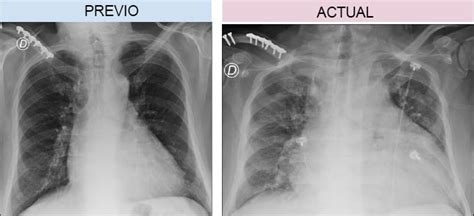 Caso Clínico Diagnóstico De Hipertensión Pulmonar Más Allá De