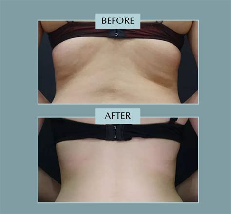 Fat Freezing Treatment Aesthetics Medispa