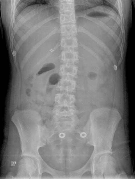 Figure 1 From Sickle Cell Anemia With Perforated Duodenal Ulcer As A Complication When To
