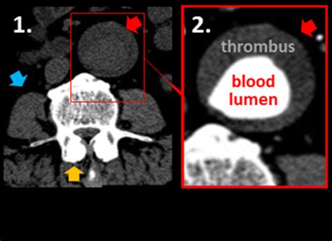Axial Slice From A Computed Tomography Ct Scan With And Without The