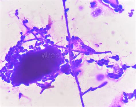 Pseudohyphae