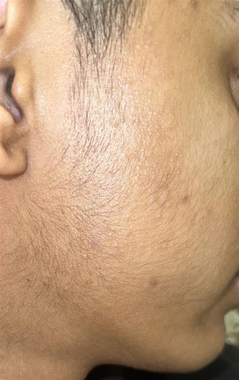 Scalp Shedding From Applying Minox On Beard R Minoxbeards