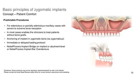 Zygomatic And Pterygoid Implants Preferred Dental Center San Antonio