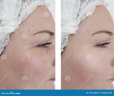 Woman Wrinkles Skin Before After Results Regeneration Mature Treatment