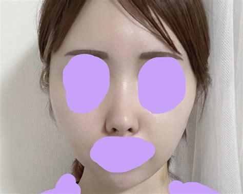 すずちゃん🫧腹部脂肪吸引、胸額脂肪注入、小鼻縮小3点、鼻孔縁下降 Dt On Twitter 1年半でこの変化🤣 いらない部分の脂肪は