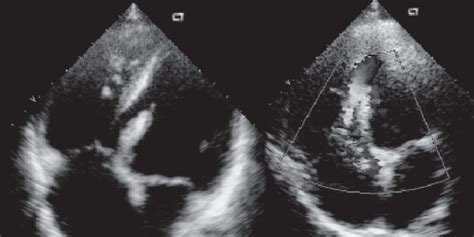 Apical 4 Chamber View Showing Oblique Muscular Vsd And Dilated Ra And