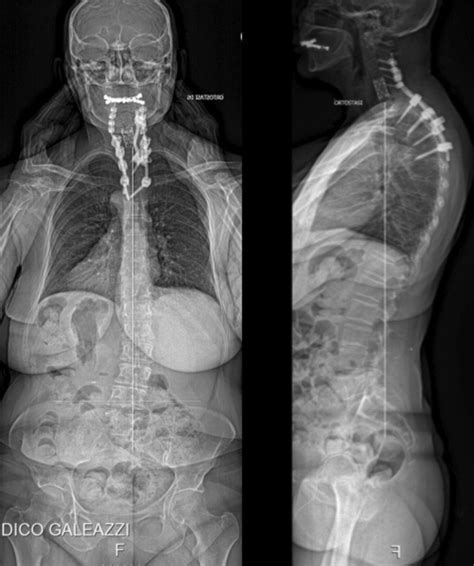 Post Operative Full Spine Films Showing Global Alignment Download