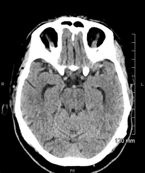 Radiopaedia Case Unilateral Anterior Cerebral Artery A1 Segment